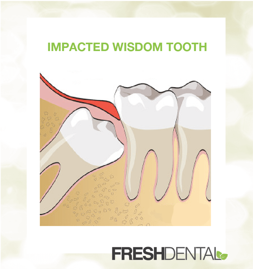 Painless Wisdom Teeth Removal In Cotswold Fresh Dental