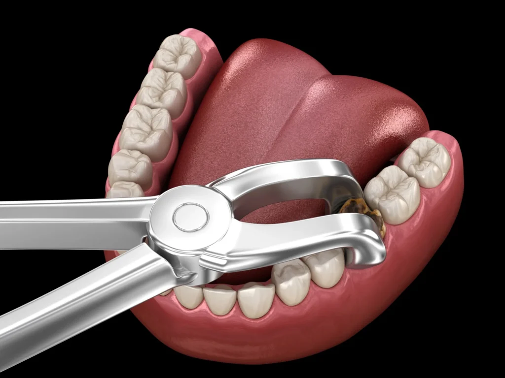 The Role of Tooth Extraction in Treating Damaged or Infected Teeth ...